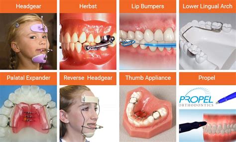 Orthodontic Appliances Types And How They Work Best Orthodontic Dentists