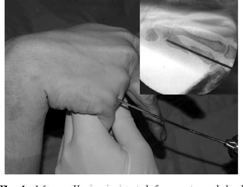 Figure 1 From Percutaneous Retrograde Intramedullary Pin Fixation For Isolated Metacarpal Shaft