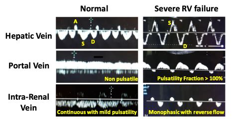 Evaluation Of Venous Congestion Using Point Of Care Ultrasonography