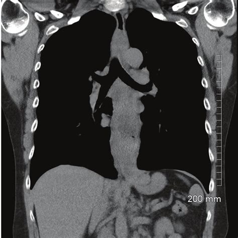 The Egd Reveals This Friable And Fungating Mass 30 Cm From The Incisors
