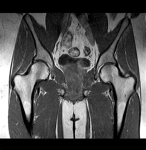 Normal Hip Mri