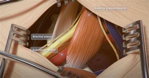 Technique Rib Resection For Tos