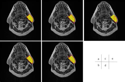 Comparison Of Manual Segmentation And A 25d Generative Adversarial