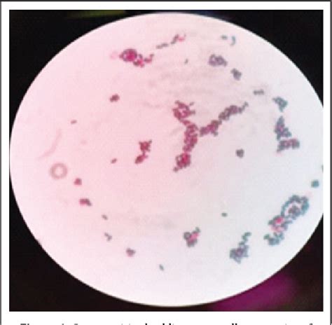 Pdf A Case Of Invasive Fungal Sinusitis By Candida Species Causing