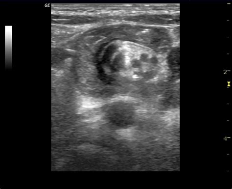 Radiopaedia Case Midgut Volvulus Id 34790 Study 36239 Nc Commons