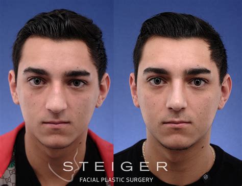 Rhinoplasty Before And After Photos