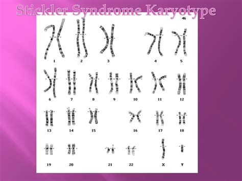 Ppt Sticklers Syndrome Powerpoint Presentation Free Download Id 2031799