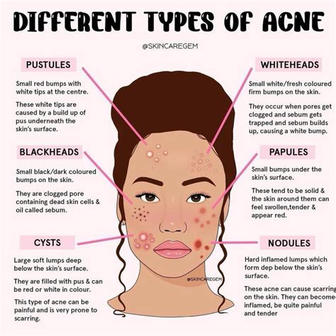What To Know About Acne Face Mapping Curology Forehead Acne Types
