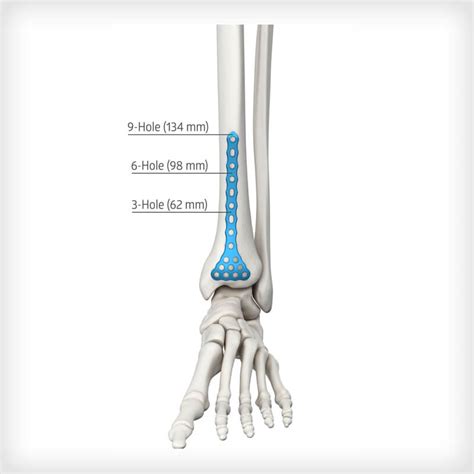 Ankle Medline Anterior Distal Tibia Plates