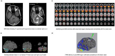 Cerebellar Lesion Detection A And B Its Functional Connectivity Map