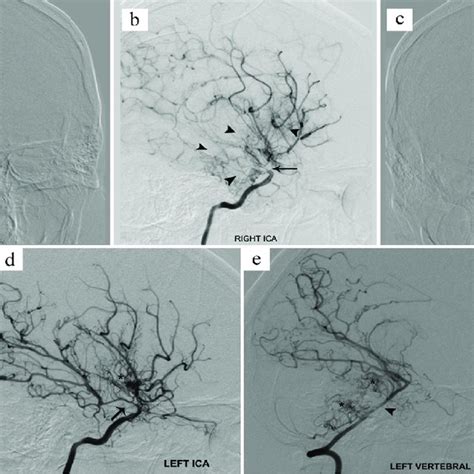 A D Axial Image Of Non Contrast Ct Brain Fig 1a B Taken At The