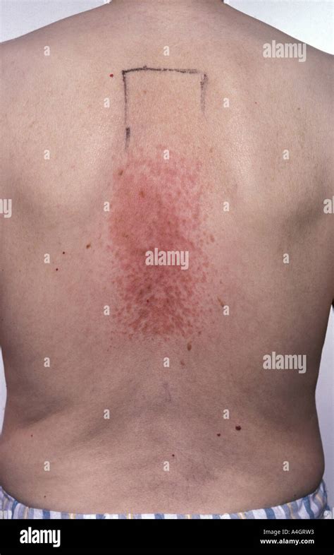 Radiation Therapy Commonly Causes A Rash Radiodermatitis Is A Common