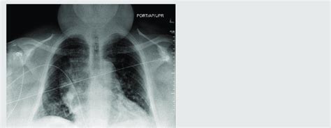 Chest X Ray Showing Large Right Medial Mid Lung Opacity Adjacent To The