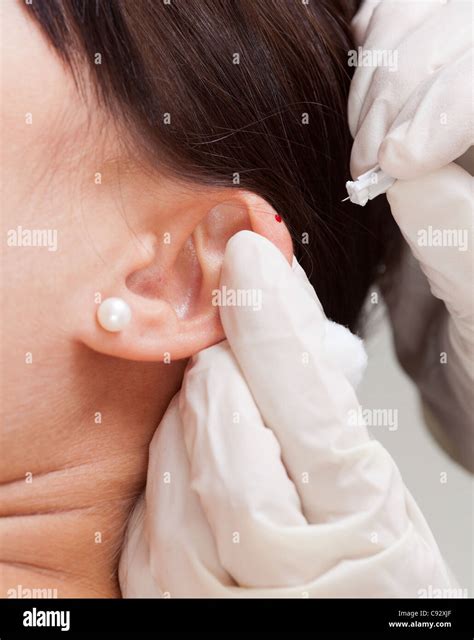 Bleeding In Ear After Acupuncture At Eugene Mash Blog