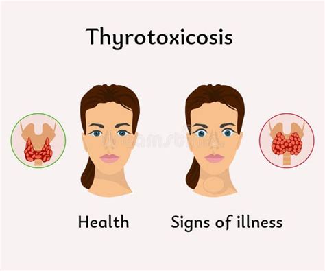 Thyrotoxicosis Thyroid Gland Medical Poster Stock Vector Illustration