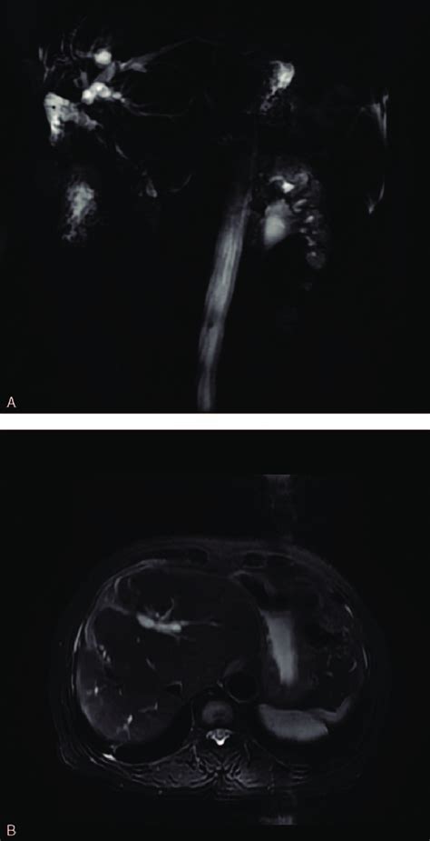A Magnetic Resonance Cholangiography Demonstrating Dilation Of Download Scientific Diagram