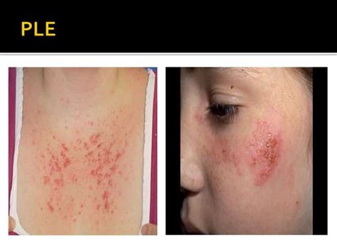 Approach To Photodermatoses Pptx