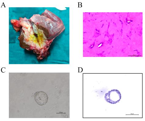 Cholangiocarcinoma Gross