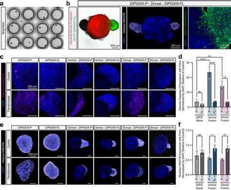 Glioma Assembloids Predict Tumor Progression Specific Drug Response A