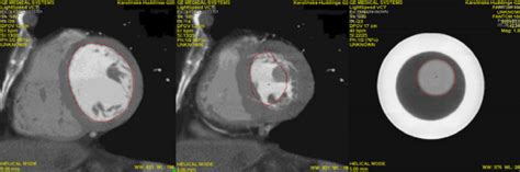Automatic Contour Detection By Msct Examples Of The Automatic