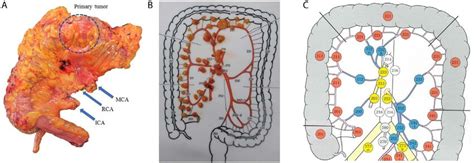 Postoperative Lymph Node Management A A Specimen Of The Transverse