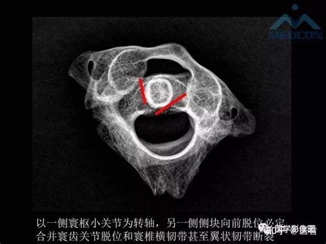 经典整理 寰枢关节脱位的影像诊断 知乎