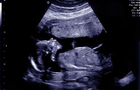 Fetal Echocardiography A Complete Guide Diagnopein