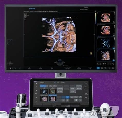 삼성메디슨 프랑스 스타트업 소니오 인수…ai 진단 기술 강화 뉴스1