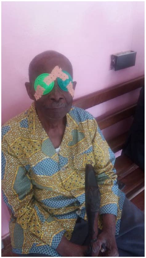 Simultaneous Bilateral Cataract Surgery Patient At Discharge