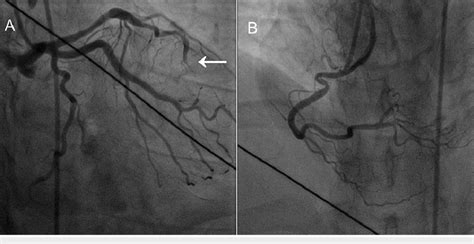 A Coronary Angiogram Showing Non Significant Proximal Coronary Lesion