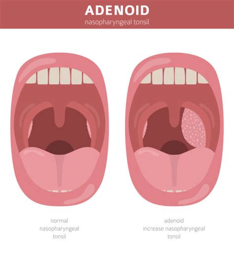 Tonsillar Hypertrophy Score