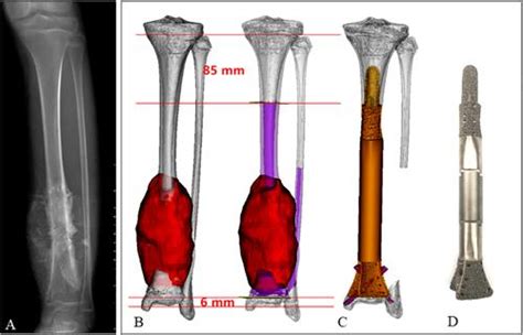 Intercalary Prosthetic Reconstruction With Three Dimensional Printed Custom Made Porous