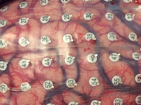 How Intracranial Brain Stimulation Affects Conscious Experience Research Communities By