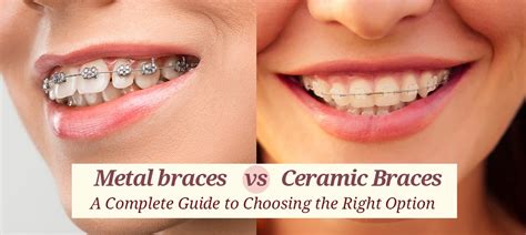 Ceramic Braces Vs Metal Braces Metal Vs Ceramic Braces Finding Your