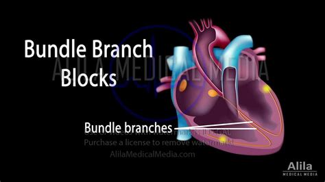 Alila Medical Media Bundle Branch Block NARRATED Animation Medical Animation