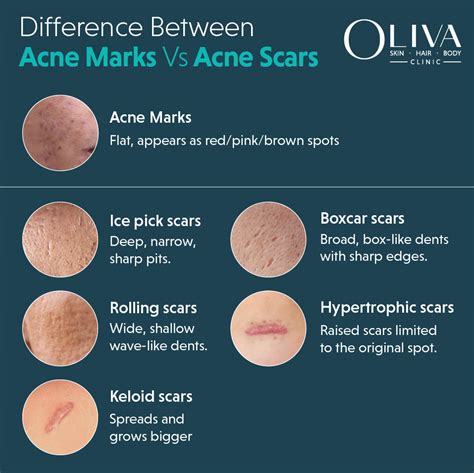 Difference Between Acne Marks Vs Acne Scars