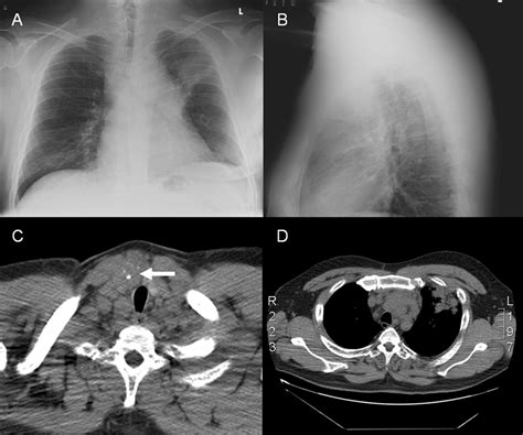 The Pa A And Lateral B Views Of The Cxr Demonstrate A Widened Download Scientific Diagram
