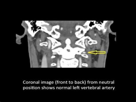 Vertebrobasilar Artery Syndrome Colorado Spine Surgeon