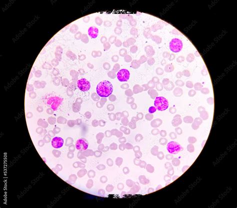 Foto De Acute Myeloid Leukemia Aml Is A Type Of Blood Cancer