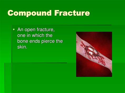Fracture Sentence Examples At Nicholas Ramsey Blog