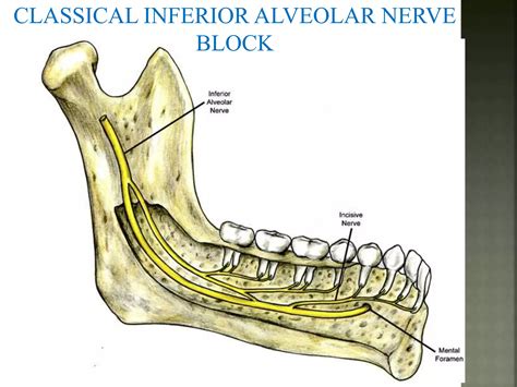 Mandibular Nerve Blocks Techniques Pptx Ear Nose And Throat
