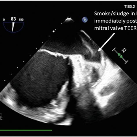 Well Formed Thrombus In The Laa Within Minutes Of Mitral Valve Teer