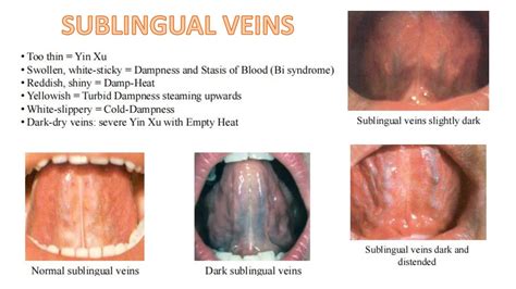 Sublingual Veins Youtube