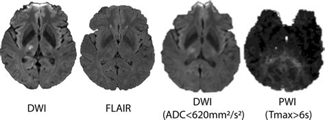 Only DWIFLAIR Mismatch Imaging Example Of A Patient With A Lacunar Download Scientific