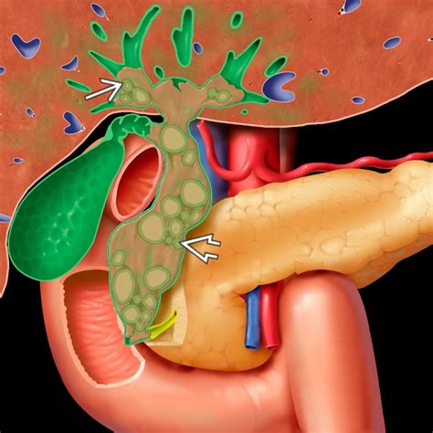 Recurrent Pyogenic Cholangitis Radiology Key Recurrent Pyogenic Cholangitis Radiology Key