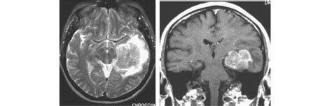 Typical Nodular Hemispheric Lesion A T2 Weighted Transverse Image In Download Scientific