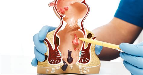 Pr Bleeding Mind The Bleep