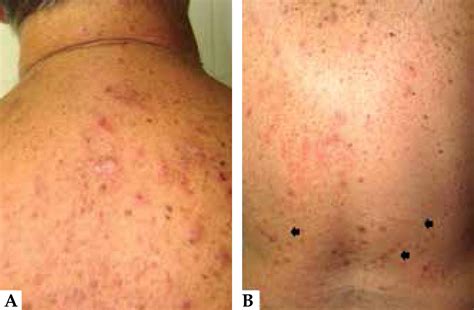 Perforating Folliculitis