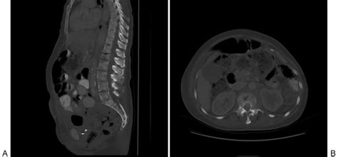 Preoperative Computed Tomography With Sagittal A And Axial B Views