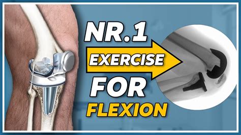 Flexion And Extension After Knee Replacement At Stephanie Fleming Blog